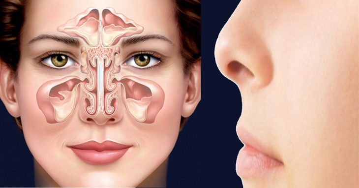 Xoang hàm trên là gì? Bệnh viêm xoang hàm trên điều trị như thế nào?